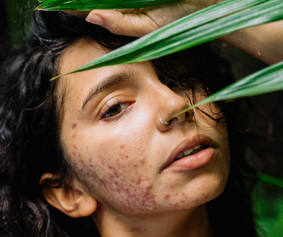 How to Treat Cystic Acne in Multicultural Skin: Expert Strategies from ...