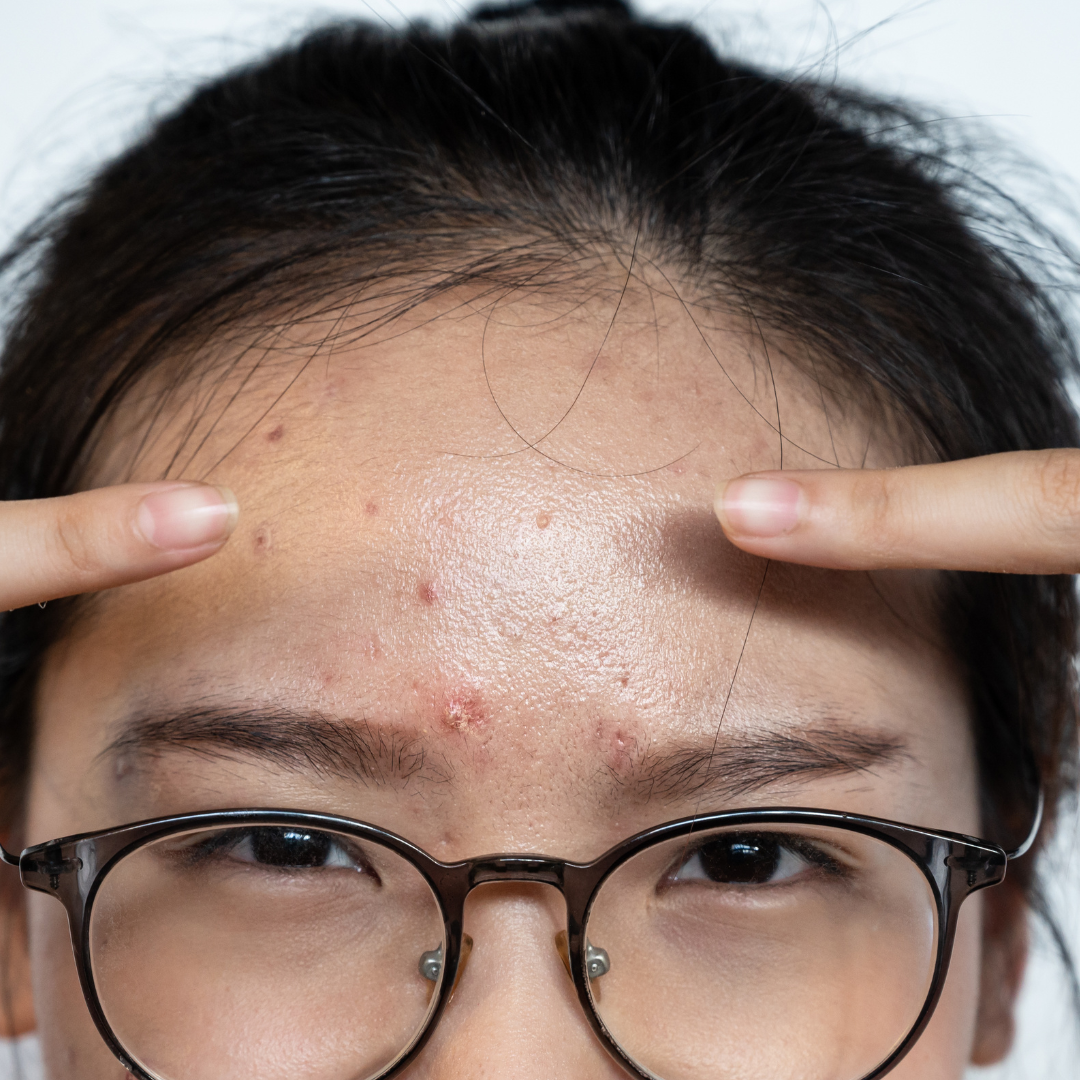 Understanding the Difference Between Acne Breakouts and Fungal Breakou ...
